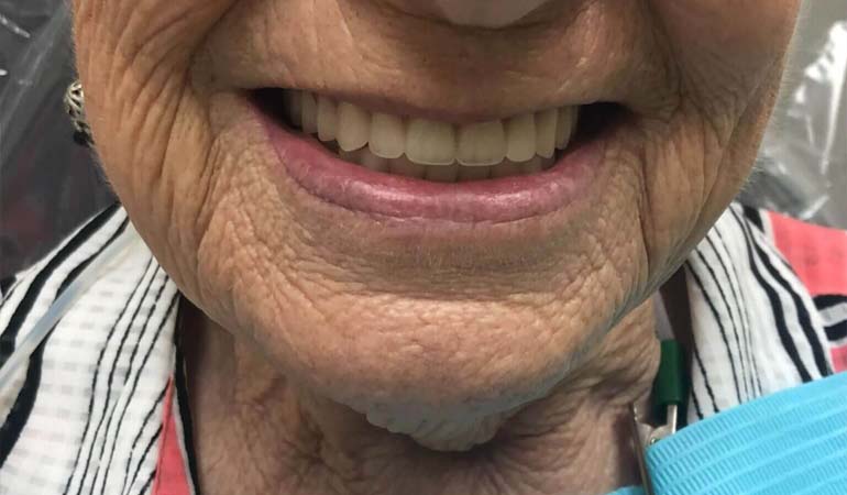 Dentures - Kind Dental